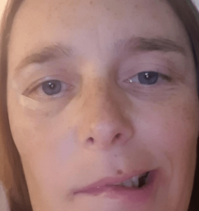 Bell's Palsy Brisbane - Laser is a Game Changer for Bell's palsy treatment